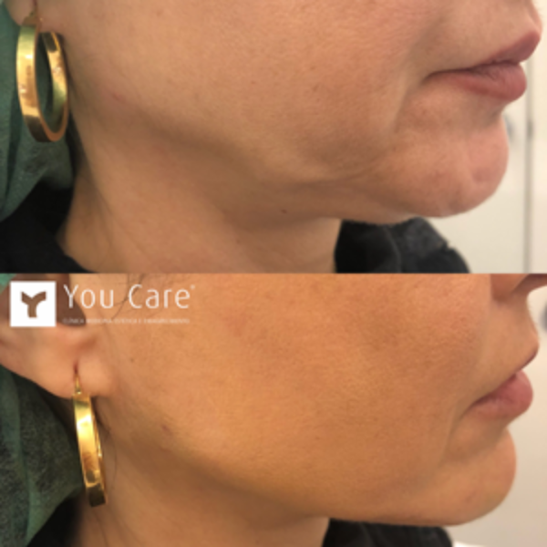 Harmonização Facial - Longevity Clinic